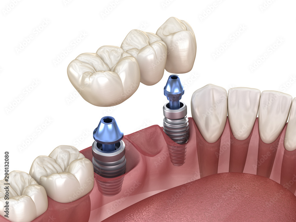 Dental bridge supported by implants. Medically accurate 3D illustration ...