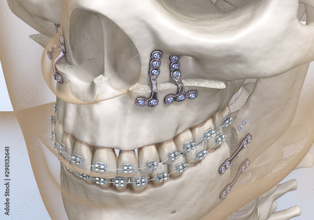 Maxillomandibular Advancement surgery. Medically accurate dental 3D ...
