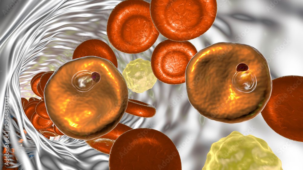Red blood cells infected with malaria parasite Plasmodium vivax, ring ...