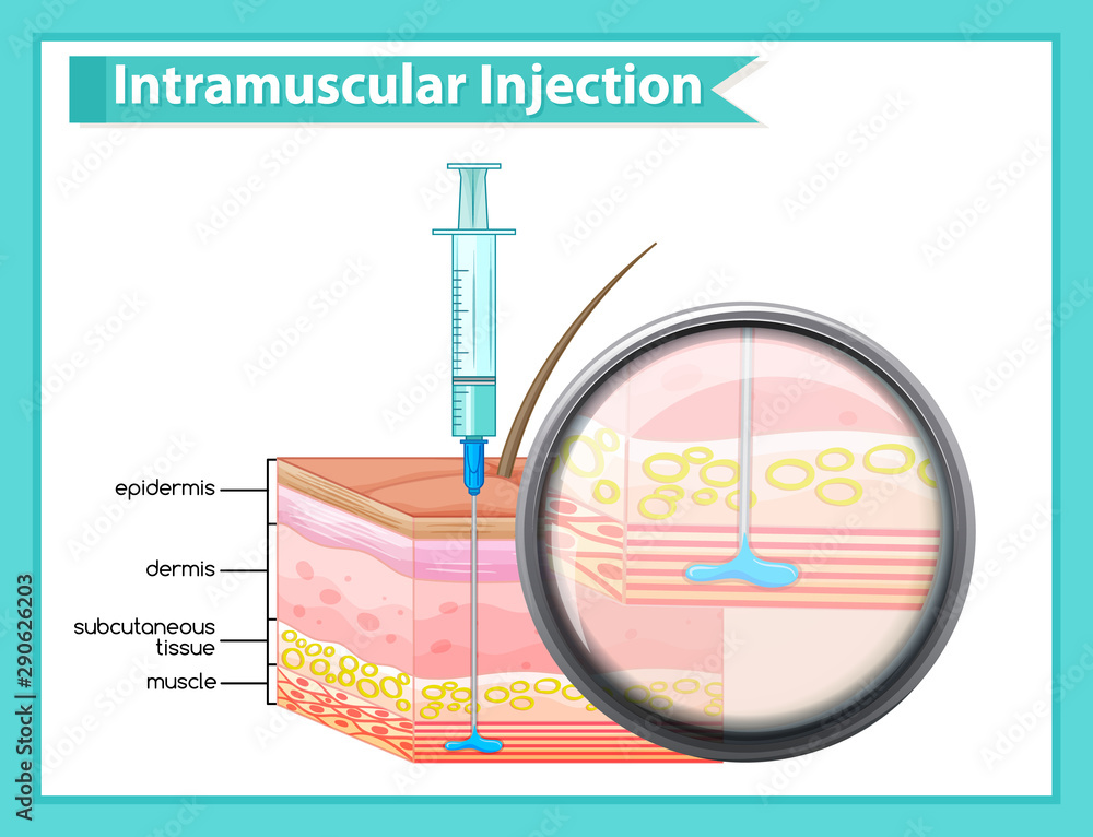 Scientific medical illustration of intramuscular injection Stock Vector ...