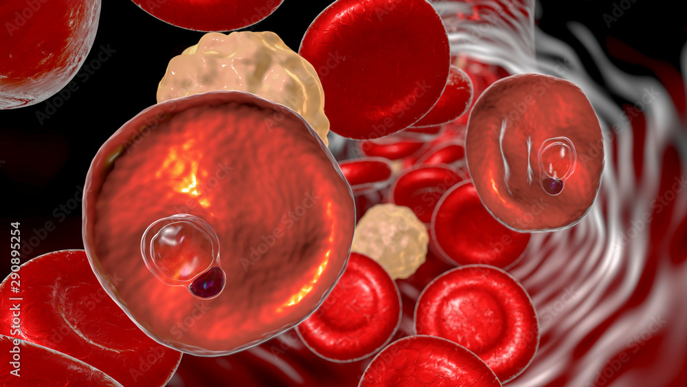 Red blood cells infected with malaria parasite Plasmodium vivax, ring ...