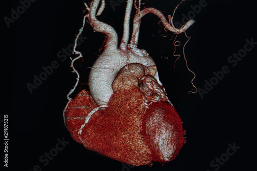X-ray medical scan heart in hospital. CTA, CT angiography 3D rendering ...