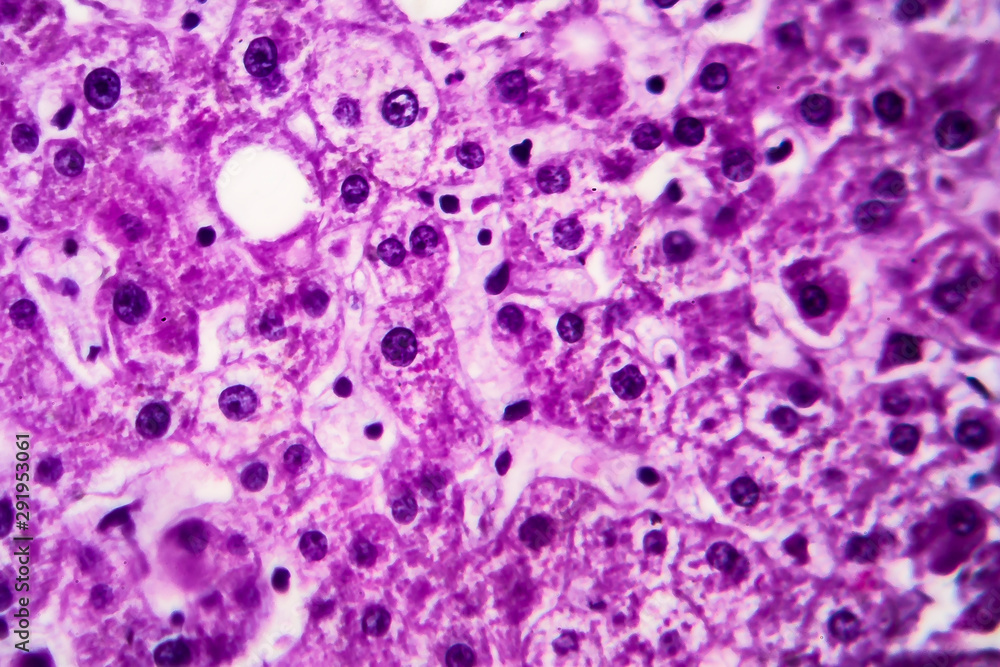 Cloudy swelling of the liver, light micrograph, photo under microscope ...