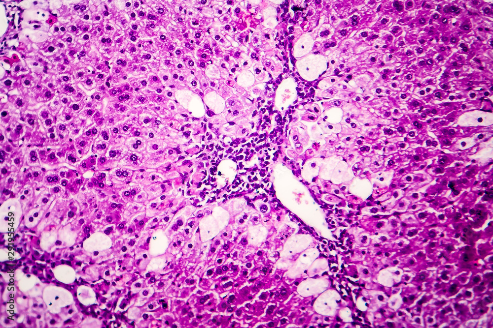 Histopathology of acute hepatitis, light micrograph, photo under ...