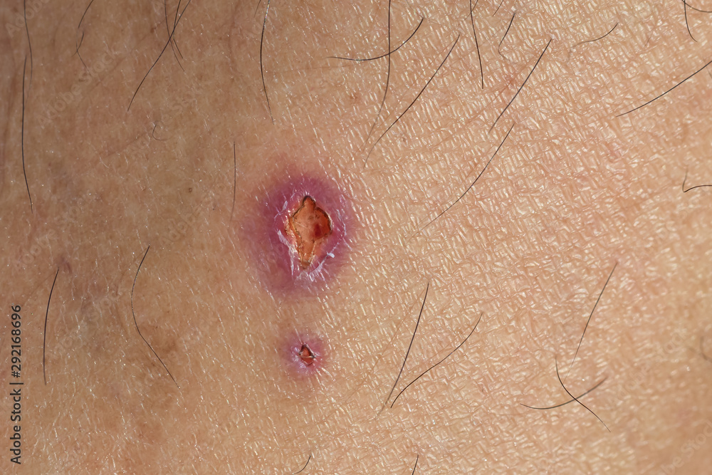 Wound infection on the skin. A wound on the human body, suture old ...