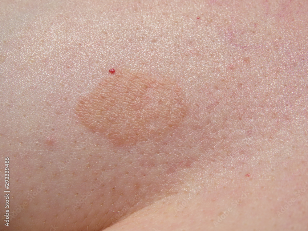 Fungal skin rash infection mark. Close up view of the patch which is ...
