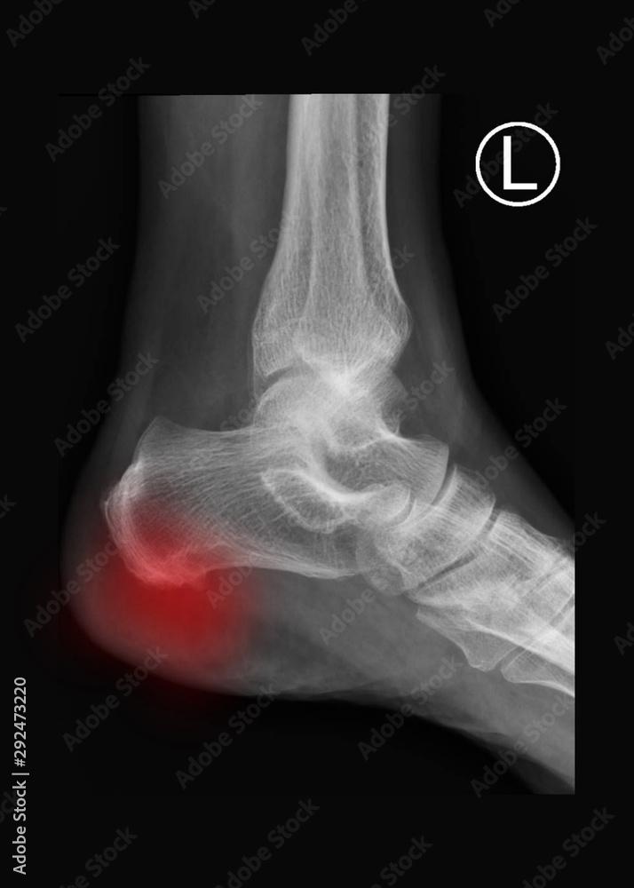 Film X-ray left lateral ankle radiograph showing spur at heel bone ...