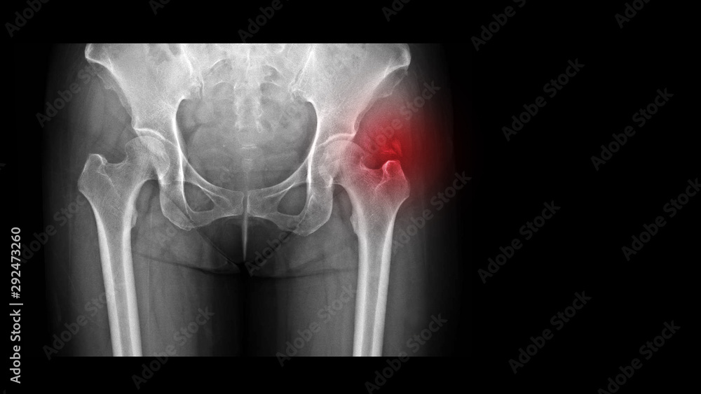 Film X-ray hip radiograph showing calcium deposit on abductor tendon of ...