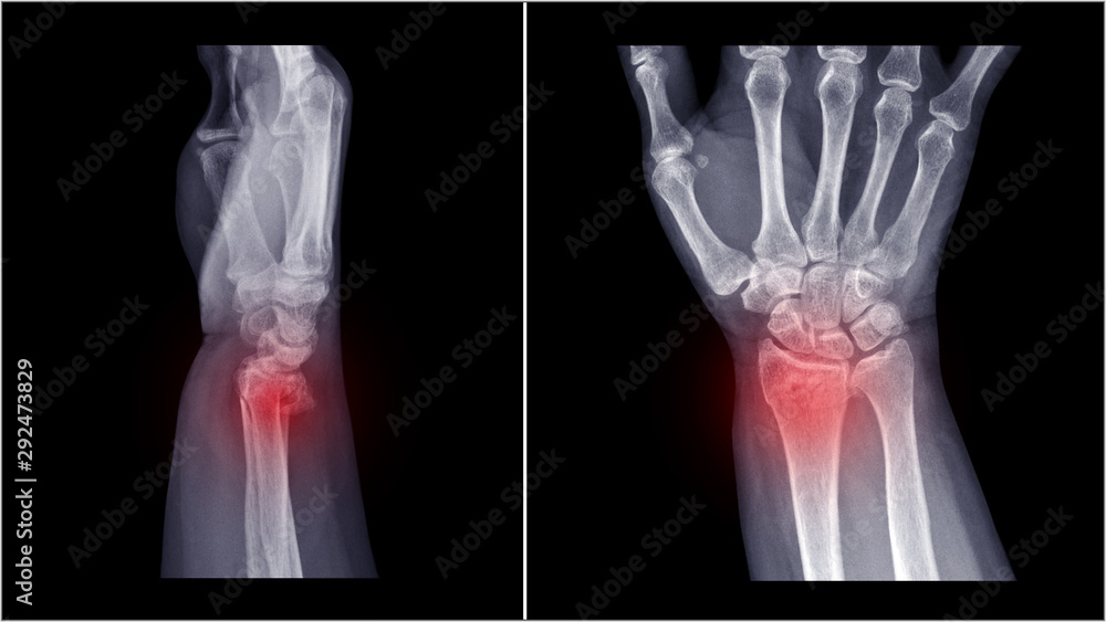 Foto stock di Film X-ray wrist radiograph show lower end of forearm ...