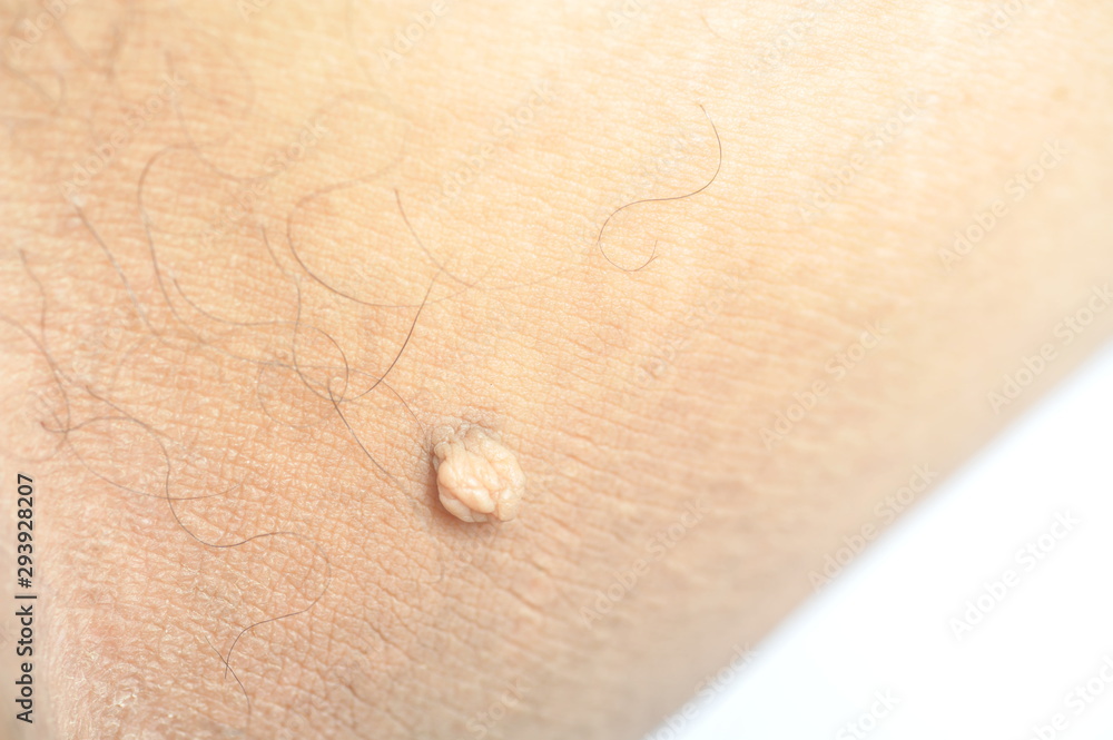 Pedunculated Mass skin tag or acrochondon or soft fibroma. Papilloma ...