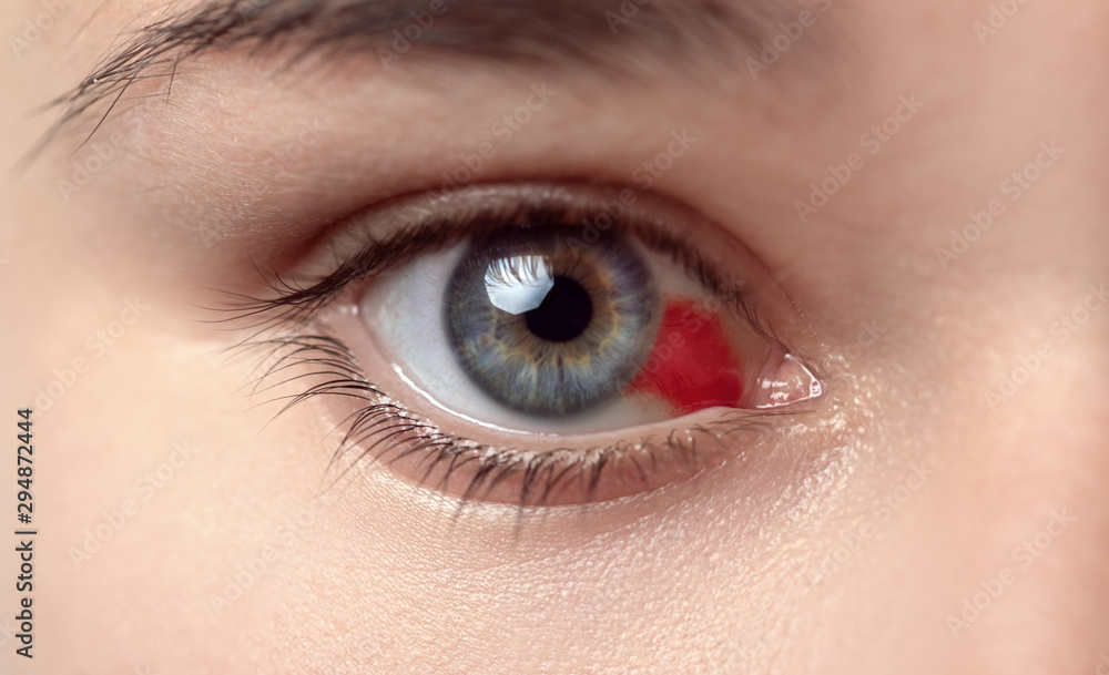 Bloodshot eye. Woman with burst blood vessel in eye. Very red bloody ...