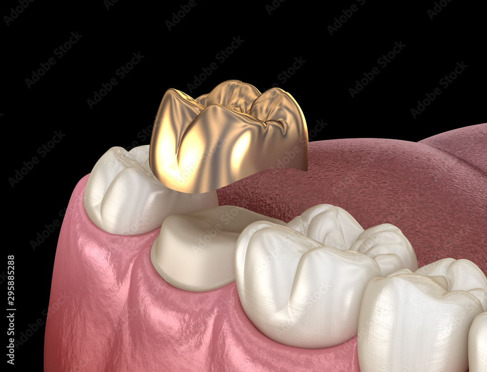Golden crown molar tooth assembly process. Medically accurate 3D ...
