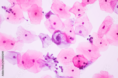 View in microscopic of abnormal human cervix cells.Koilocyte cell ...