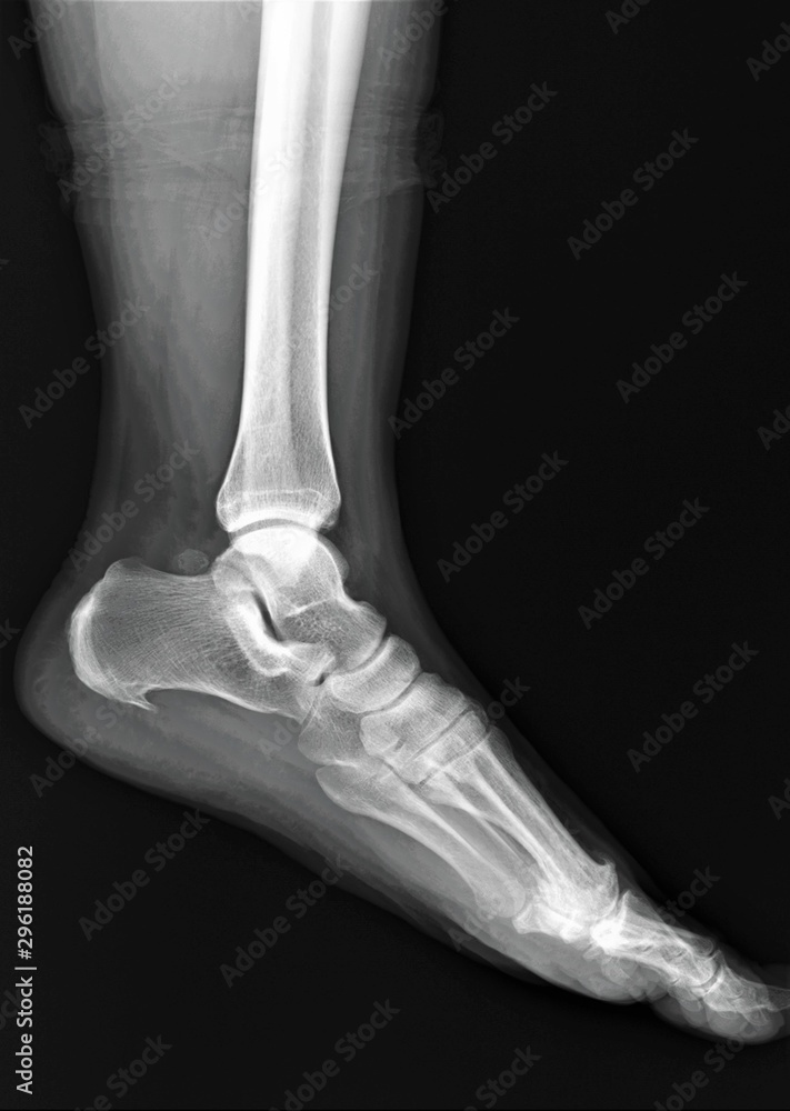 normal radiograph of the ankle joint Stock Photo | Adobe Stock