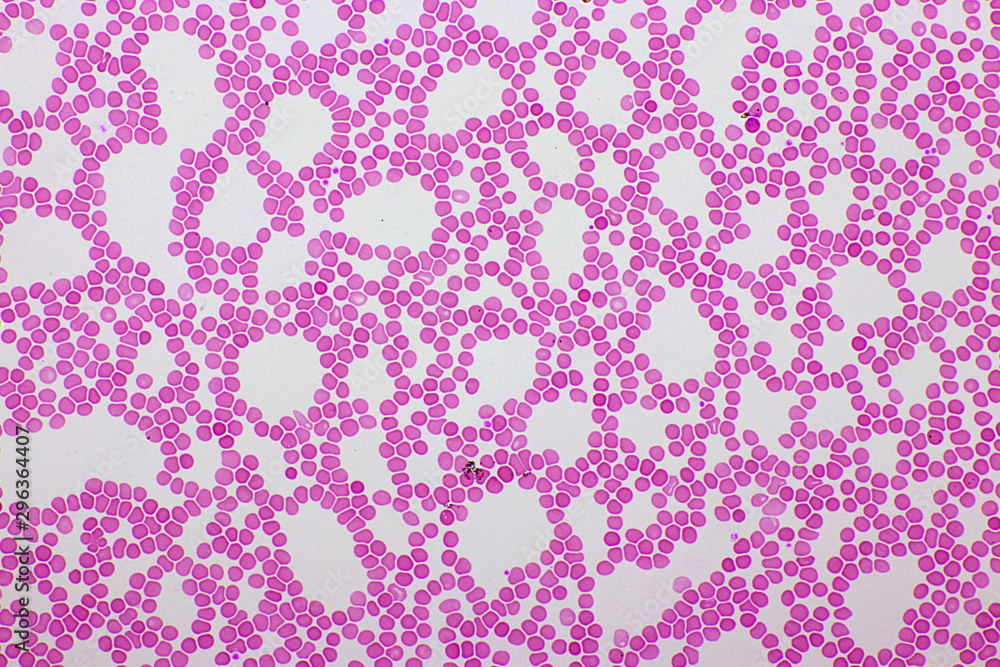 Red blood cells in blood smear, Wright-Giemsa stain, analyze by ...