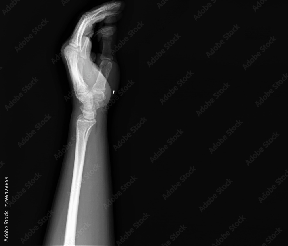 normal radiography of hand and wrist bones, traumatology and ...