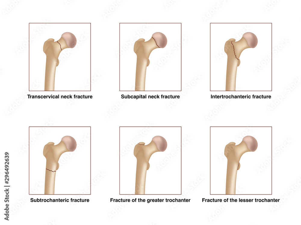 Six types of femoral neck fracture. Realistic drawing showing broken ...