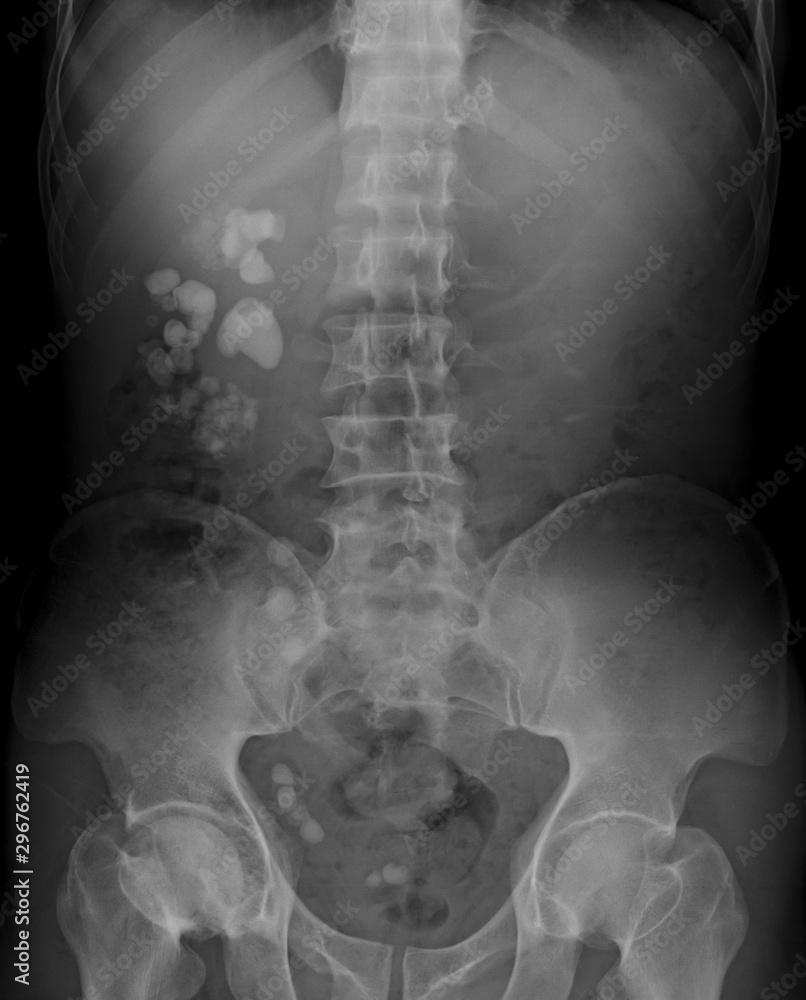 X-ray image of urinary system (kidnery, urinary and bladder: KUB ...