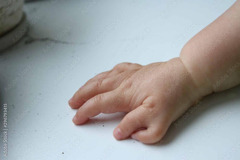 Polydactyly Preaxial, Polydactyly on human; rare abnormal ...