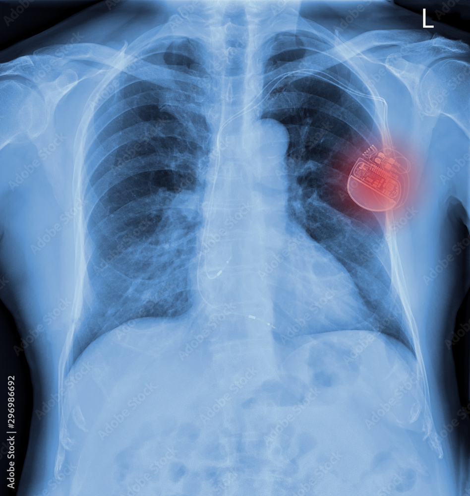 Chest X-ray with pacemaker placement Stock Illustration | Adobe Stock