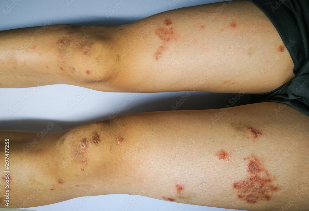 Foto de Stock Young boy has Chronic rash on skin. Grass allergic skin ...