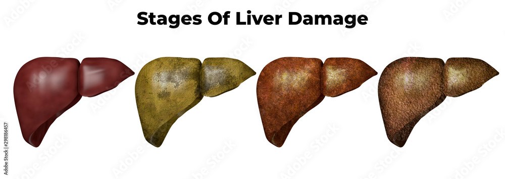 Illustration Stock Stages of liver damage. The first symptoms of liver ...