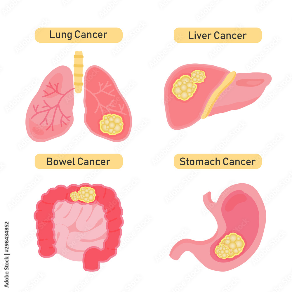 Cancer types flat vector illustration. Stock Vector | Adobe Stock