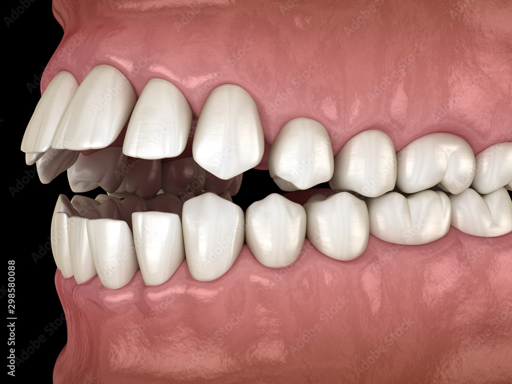 Openbite dental occlusion ( Malocclusion of teeth ). Medically accurate ...