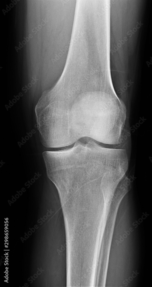 normal radiography of the knee joint in lateral projection, medical ...
