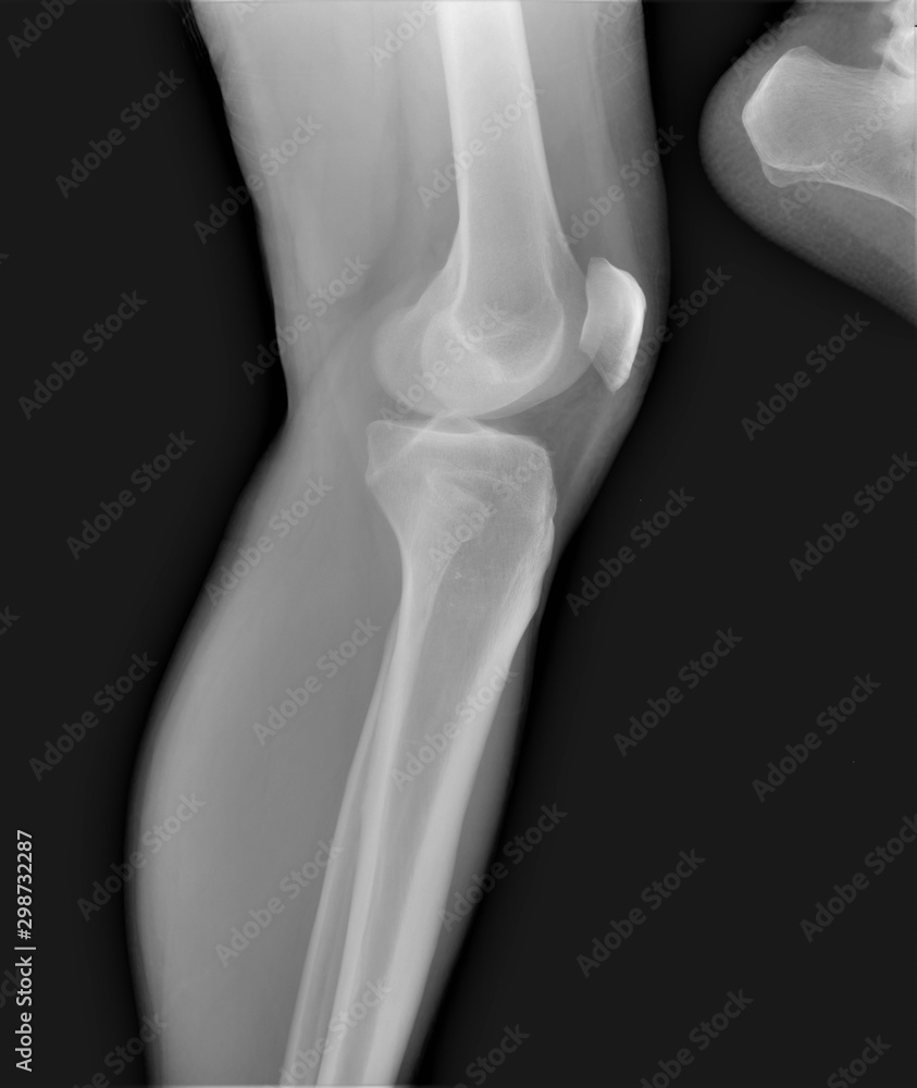 normal radiography of the knee joint in lateral projection, medical ...