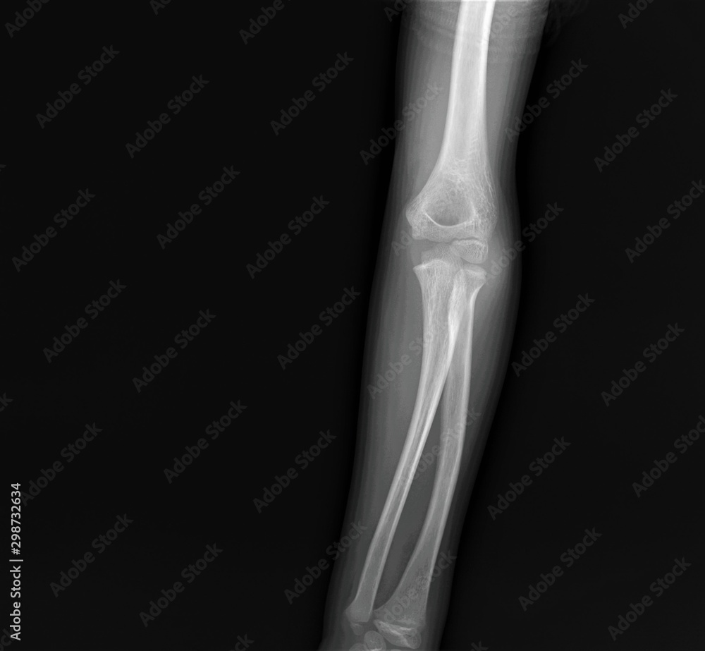 x-ray of the normal elbow joint. traumatology and orthopedics, medical ...