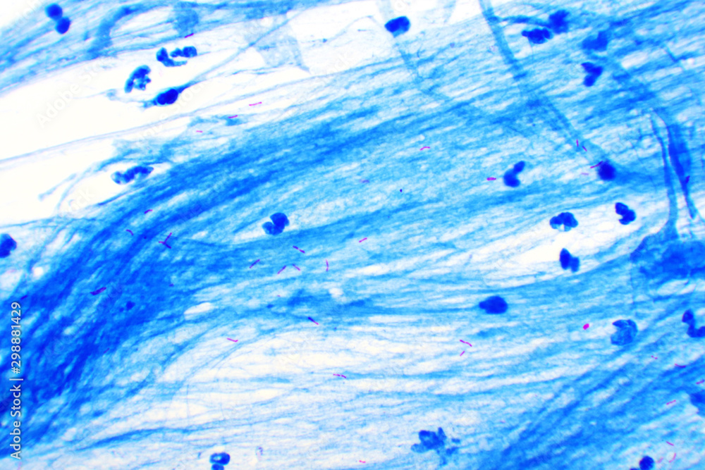 Acid-fast bacilli positive (small red rod) in sputum smear, analyze by ...