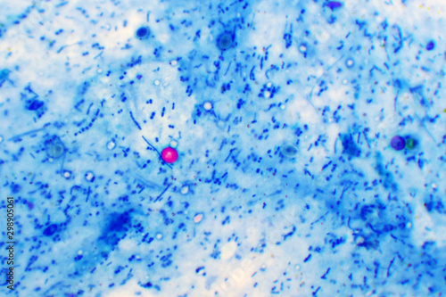 Cryptosporidium parvum protozoa positive (red sphere shape) in human ...
