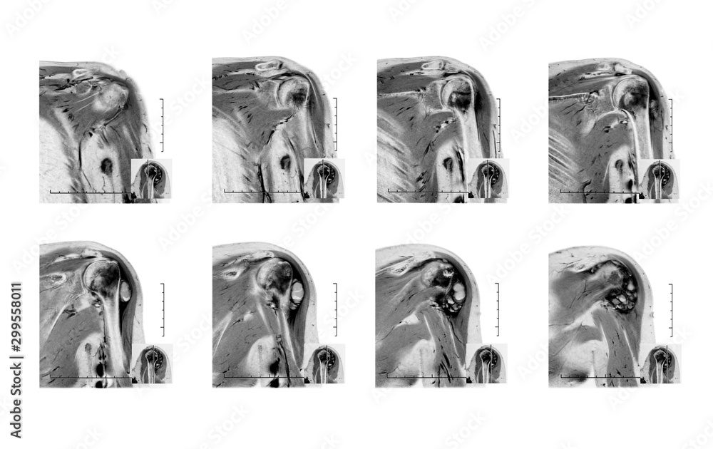 Magnetic resonance imaging (MRI scan) of shoulder joint pain Stock ...