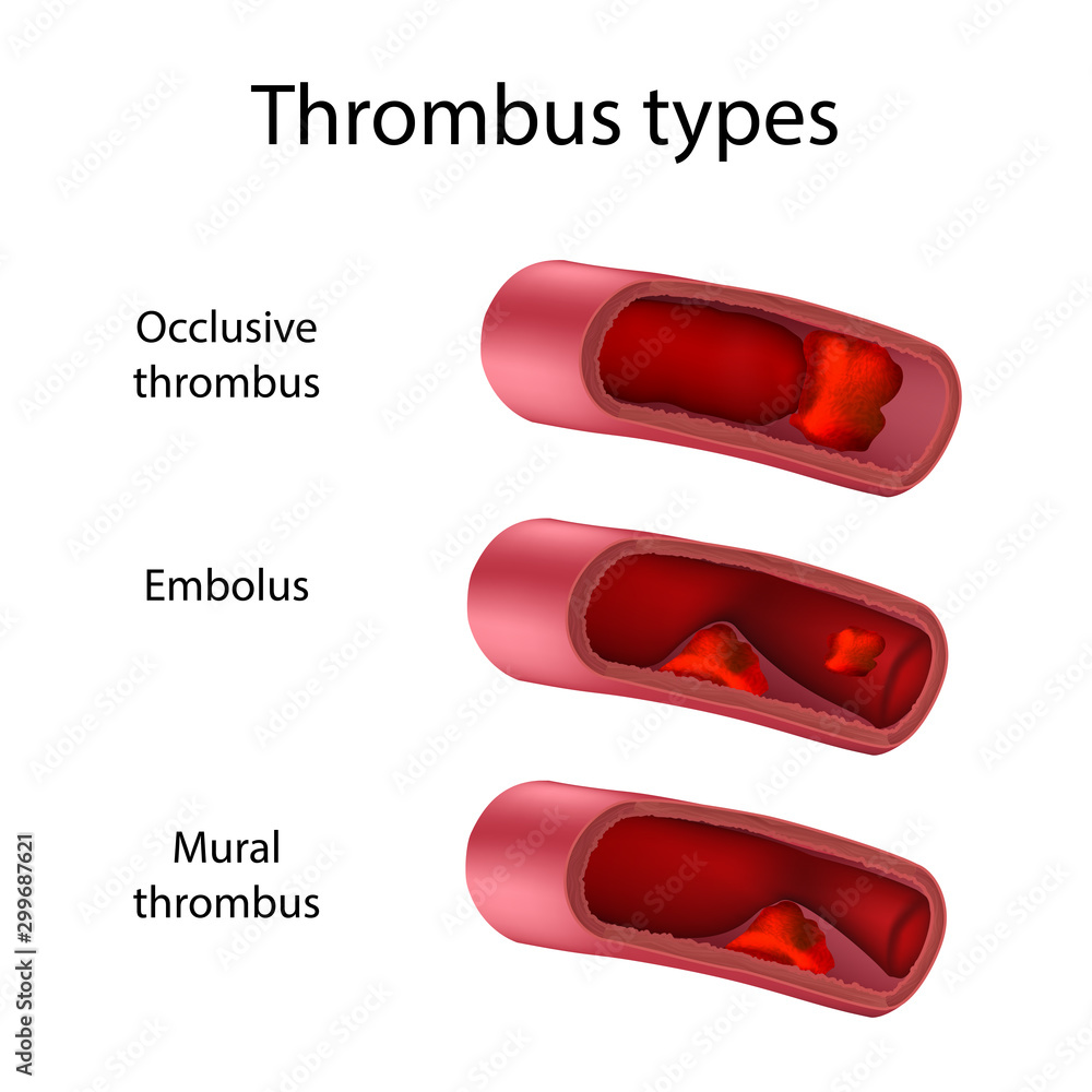 Thrombus types, occlusive, embolus, mural. Medical anatomy illustration ...