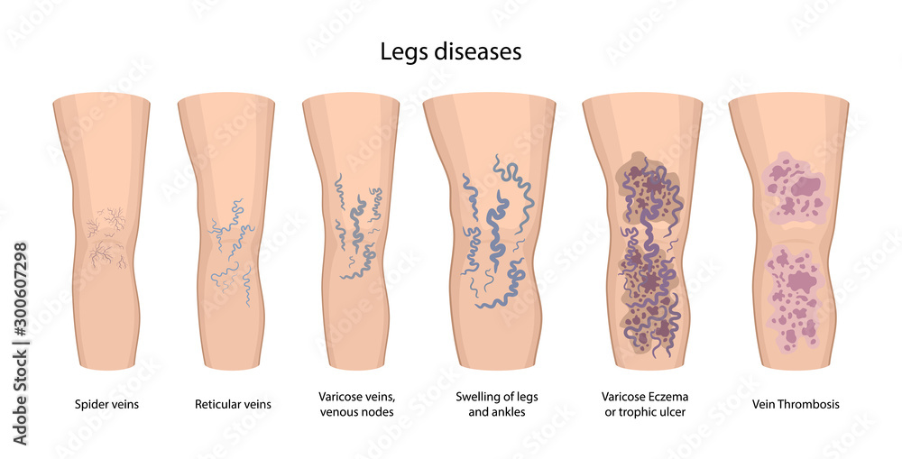 Legs diseases: spider, reticular, nodes, swelling, discoloration skin ...