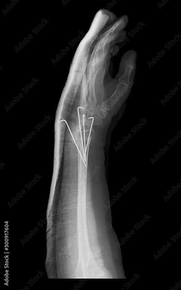 X-ray image of wrist joint with half plaster cast showing distal radius ...