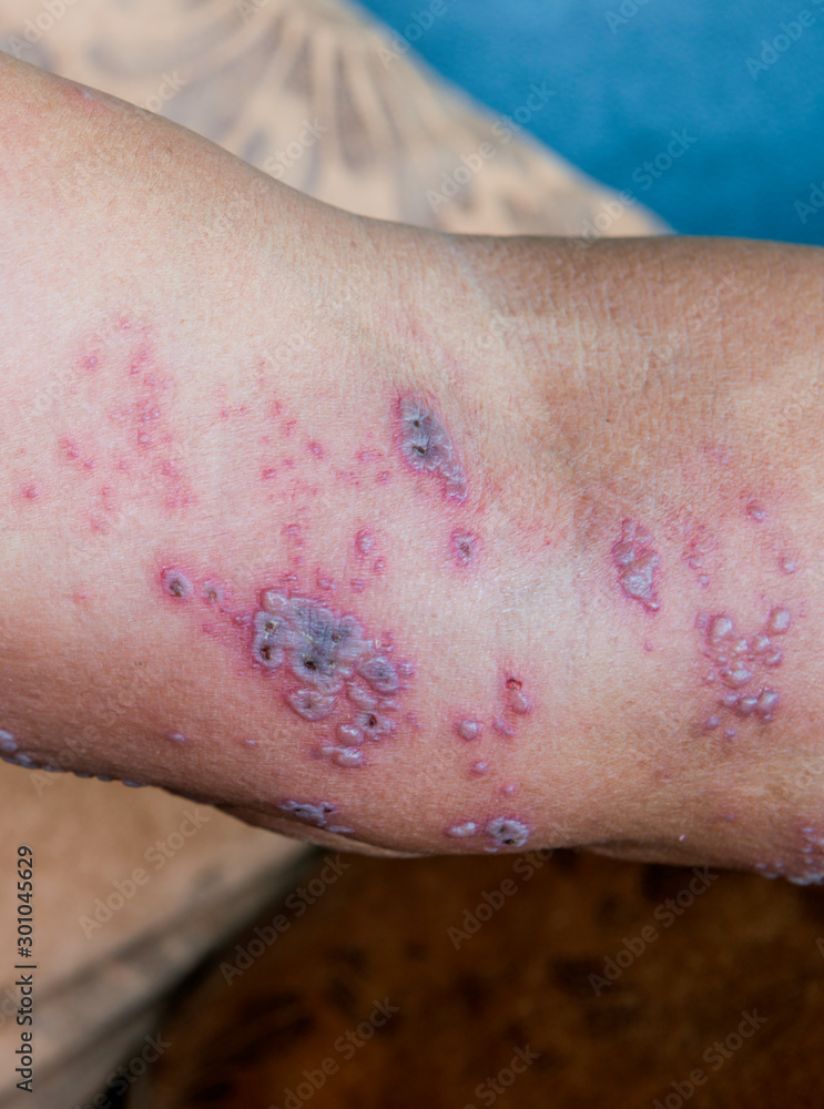 Skin infected Herpes zoster virus.Shingles (Disease), Herpes zoster ...