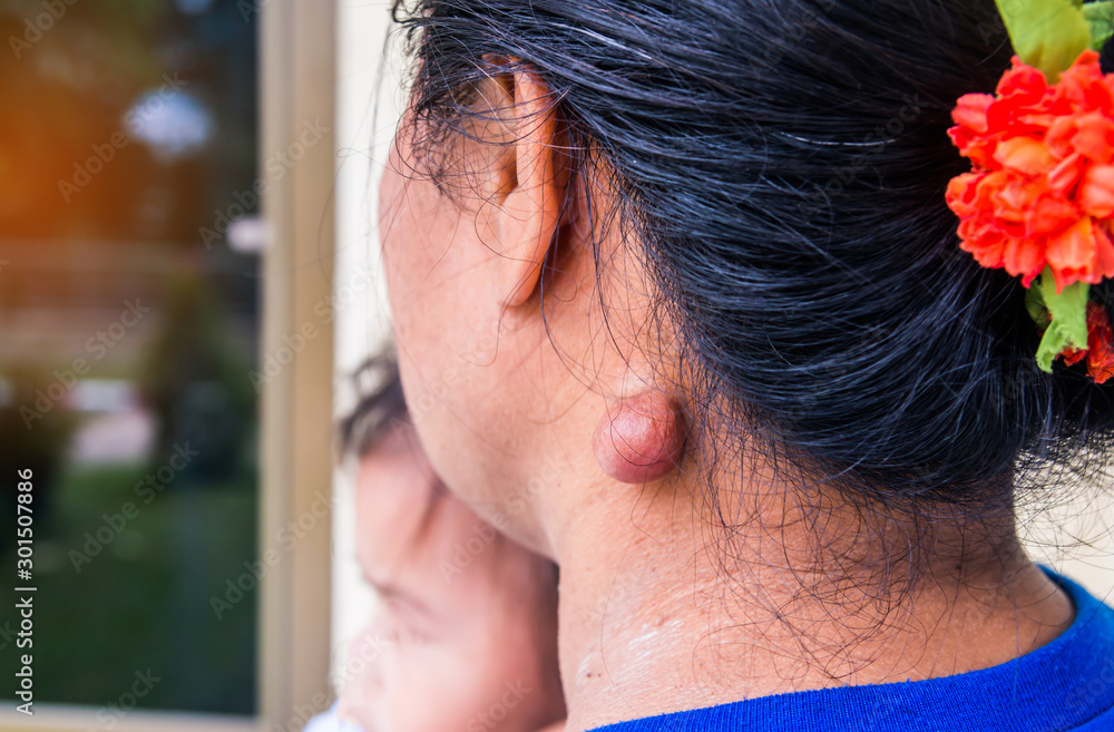 Sebaceous cyst on the neck woman form out of sebaceous gland the oil ...