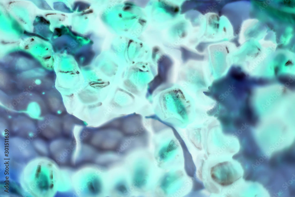 cancer cells under the microscope. Tissues affected by cancer cells ...