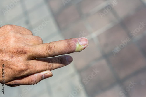 Paronychia, swollen finger with fingernail bed inflammation due to ...