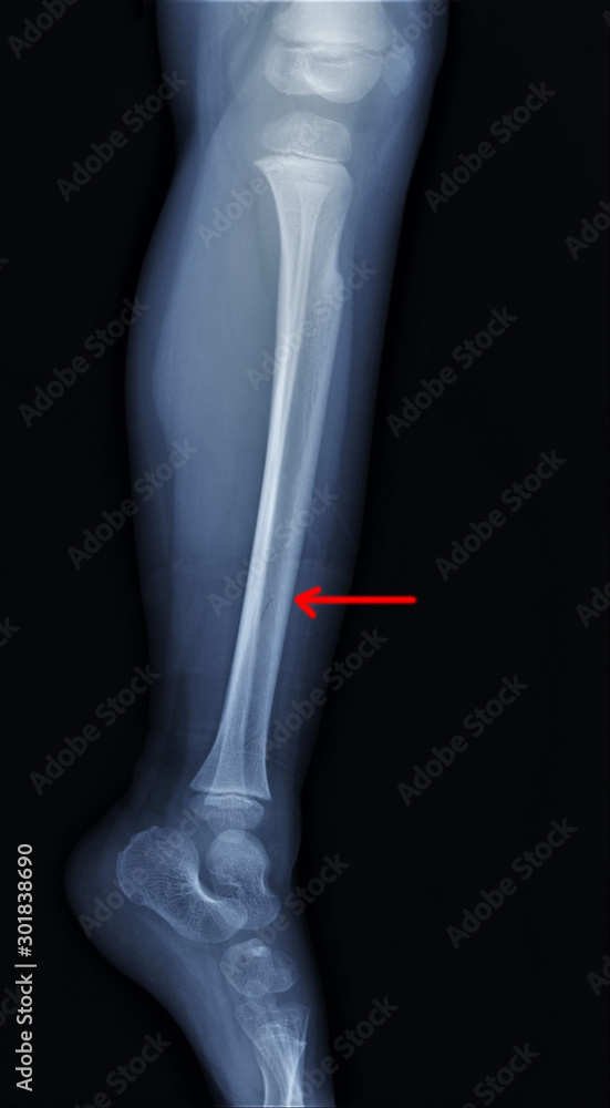 radiography of the tibia in lateral projection with tibial fracture ...