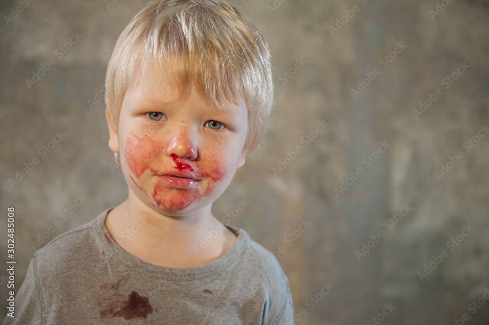 little fair-haired boy is smeared with blood. baby has weak vessels in ...
