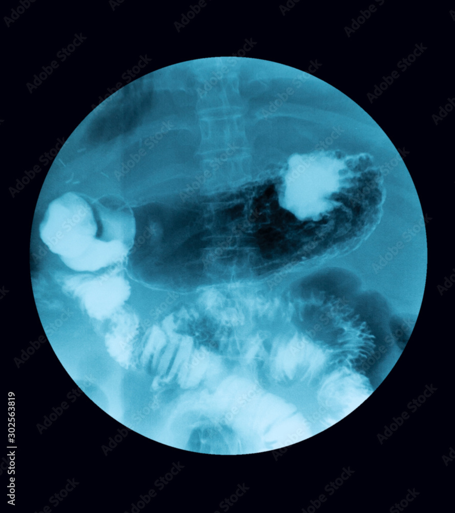 Barium meal examination of stomach and duodenum, case of ...