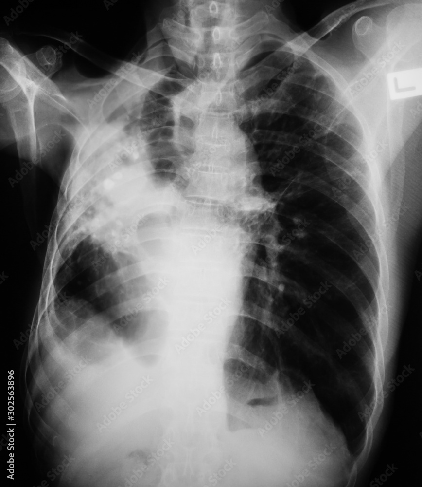 Foto de Stock Chest x-ray image showing pulmonary tuberculosis (TB ...