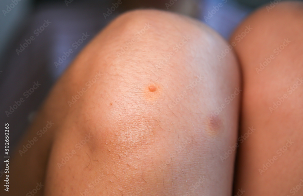 Wart on the knee. Mole on woman's leg. Papilloma problem. Skin disease ...