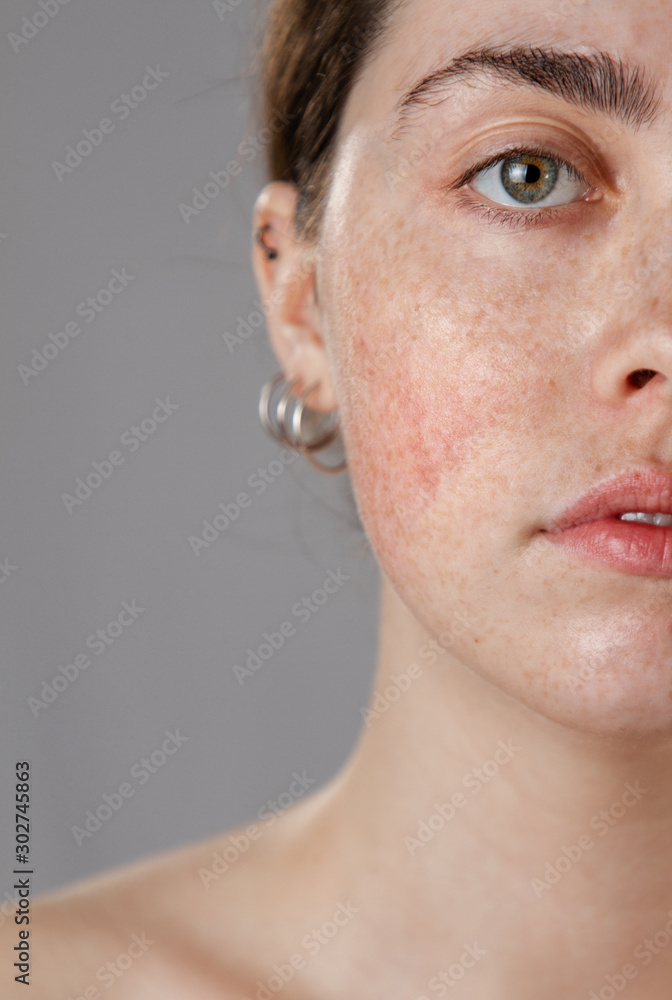 Cosmetology and rosacea. Portrait of half the face of a young woman ...