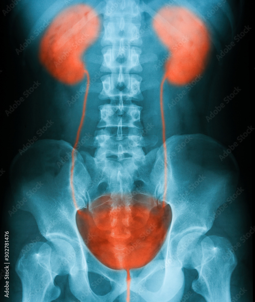 X-ray image of Urinary tract infection, urolithiasis disease in kidney ...