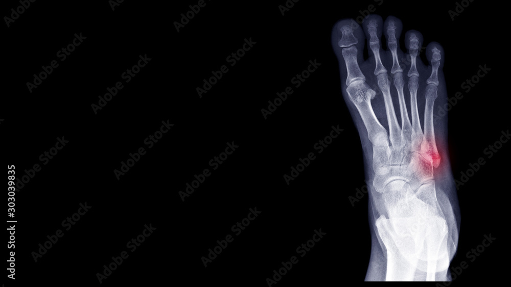 Film foot X ray radiograph show toe bone broken ( base of metatarsal ...
