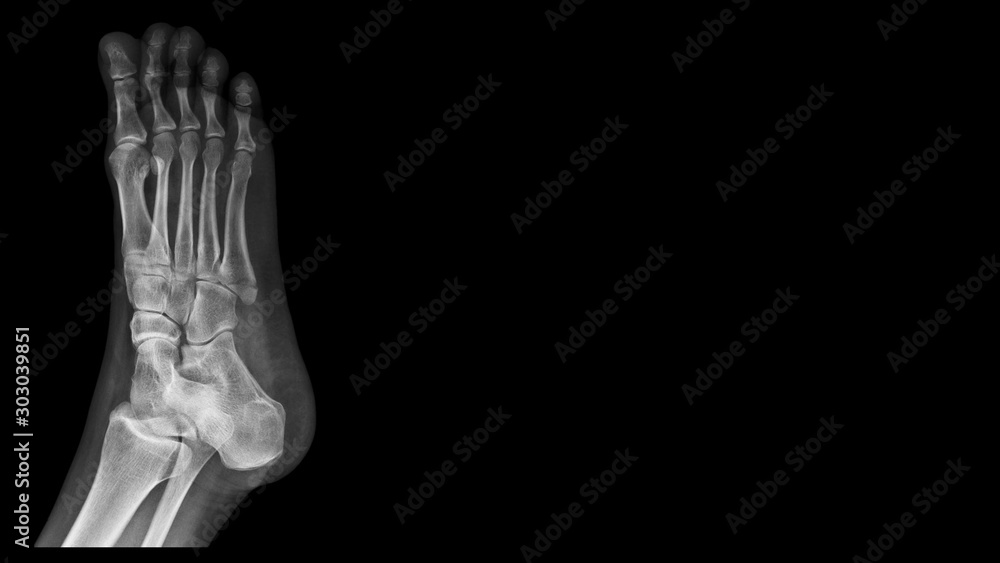 Film foot X ray radiograph show toe bone broken ( base of metatarsal ...